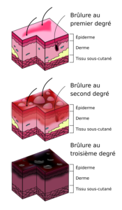 Brûlures - Urgence CHU Sainte-Justine