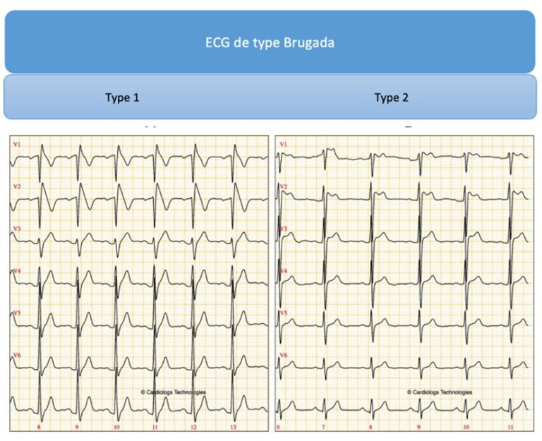 ECG pédiatrique - Urgence CHU Sainte-Justine