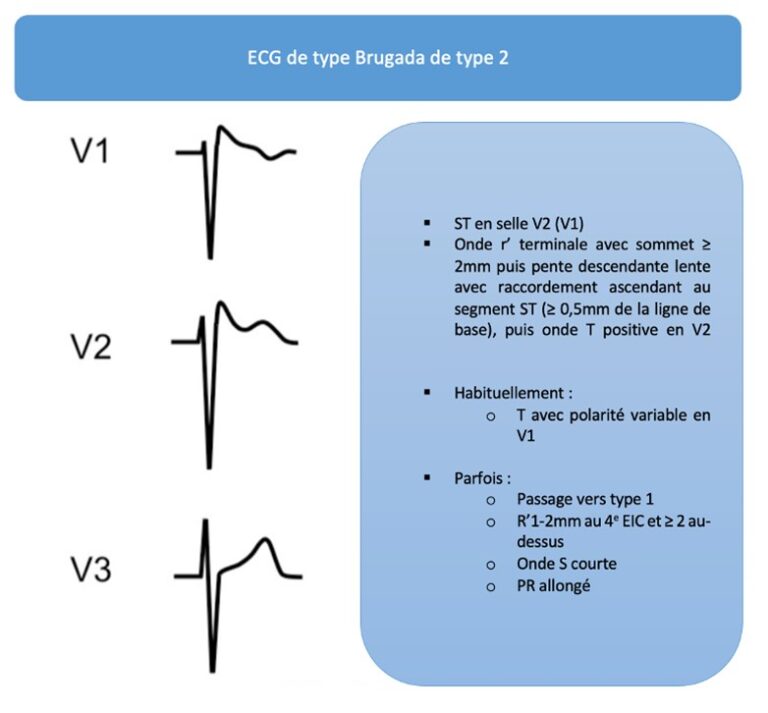 ECG pédiatrique - Urgence CHU Sainte-Justine