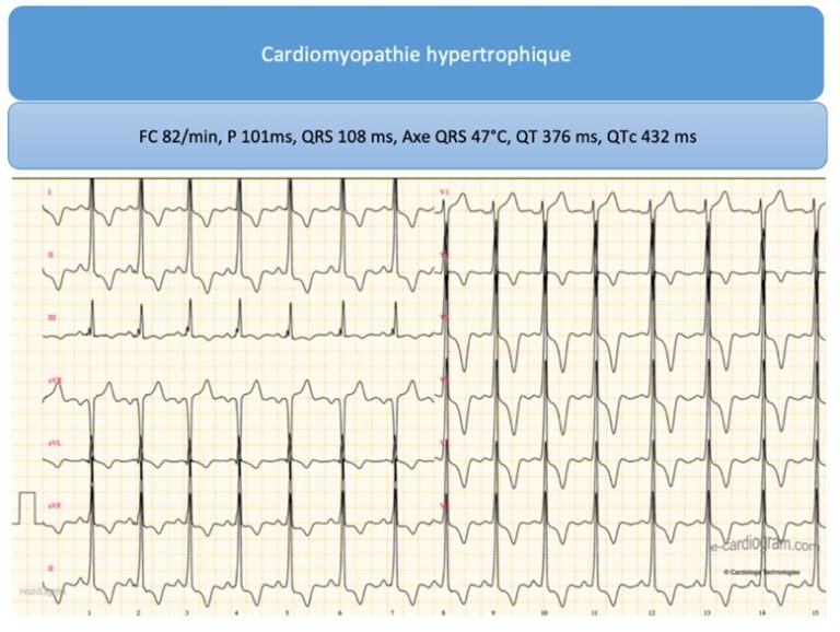 ECG pédiatrique - Urgence CHU Sainte-Justine
