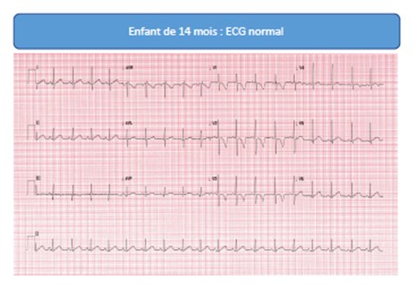 ECG pédiatrique - Urgence CHU Sainte-Justine