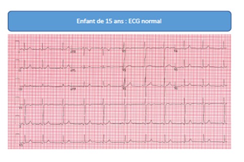 ECG pédiatrique - Urgence CHU Sainte-Justine
