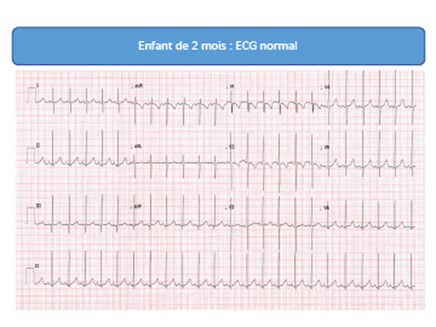 ECG pédiatrique - Urgence CHU Sainte-Justine