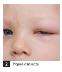 Cellulite préseptale (périorbitaire) et orbitaire - Urgence CHU Sainte ...