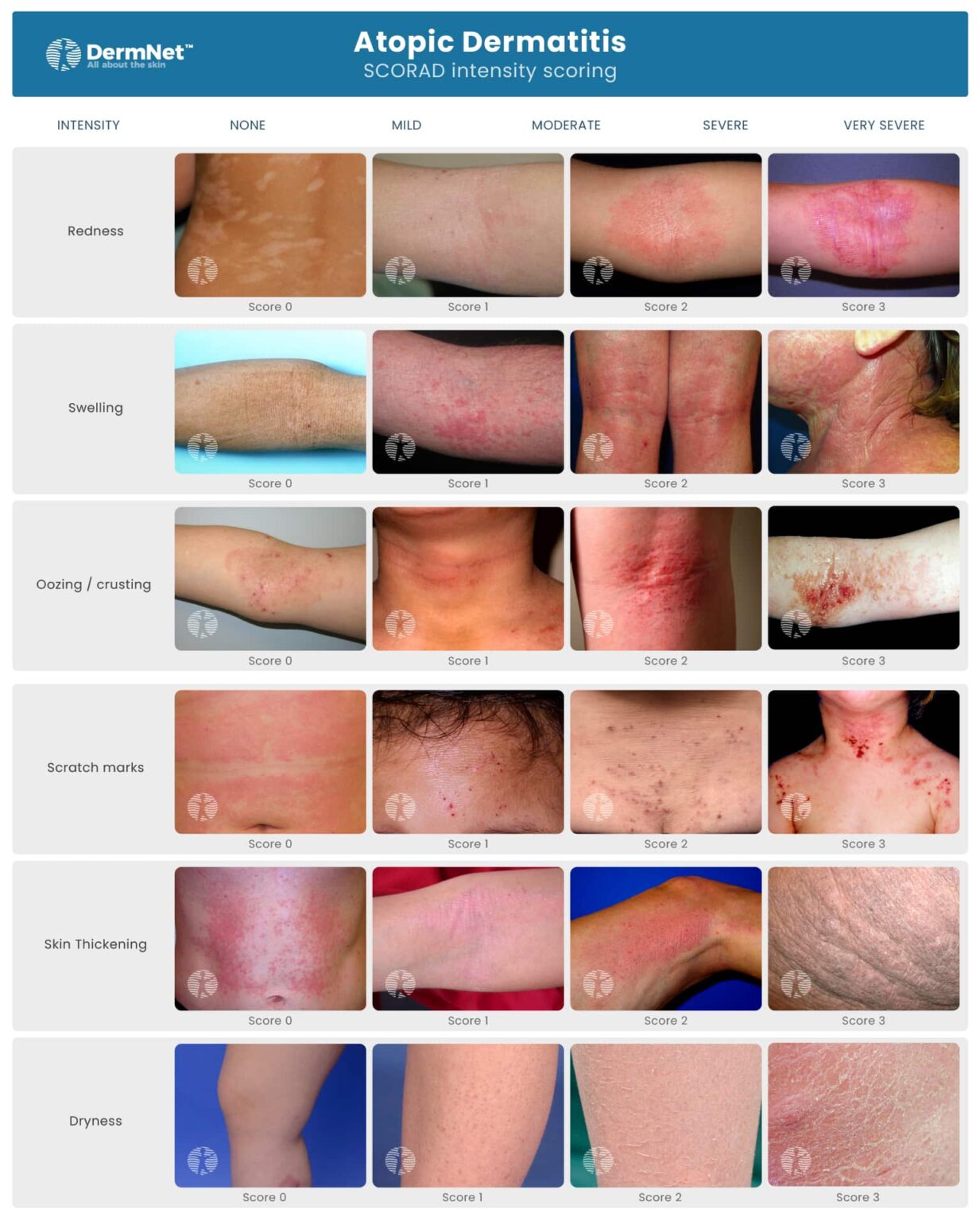 Dermite atopique- Eczéma - Urgence CHU Sainte-Justine